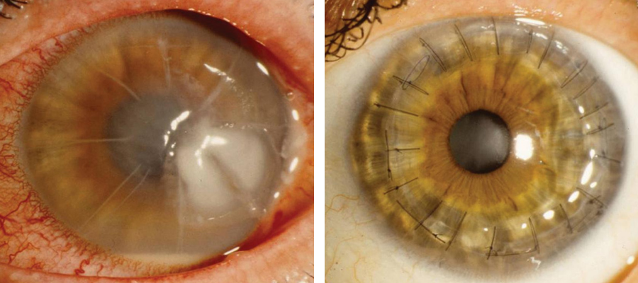 Cornea Surgery Outcomes | Mass Eye and Ear